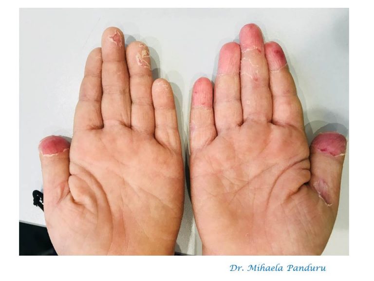 Eczema mâinilor - Dr. Mihaela Panduru - medic dermatolog